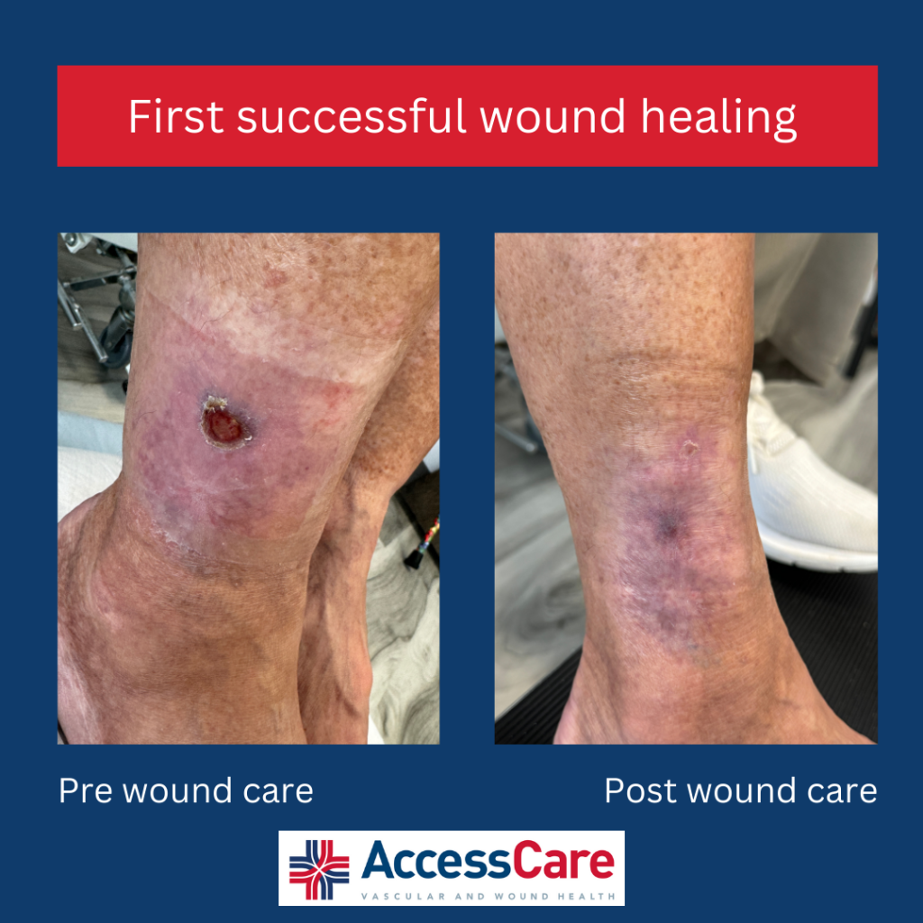 First successful wound healed!!!! - BEVSA - Buffalo Endovascular ...