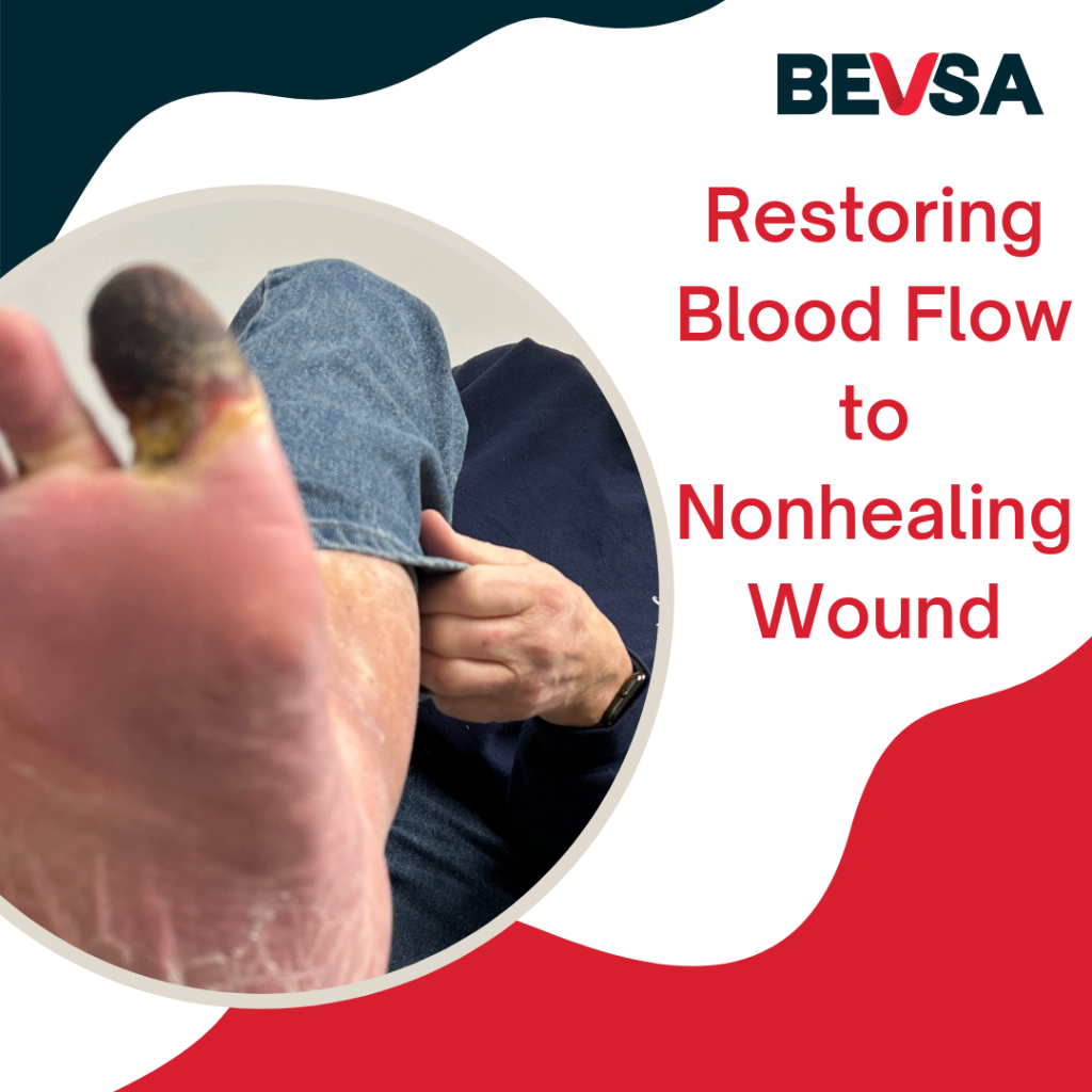 Restoring Blood Flow to Nonhealing Wound - BEVSA - Buffalo Endovascular ...